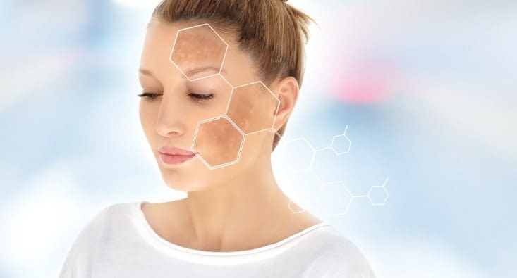 Is Hyperpigmentation on Your Face Here to Stay? Discover the Real Fix ...